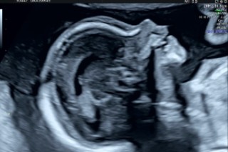 Fetal and Gynae Imaging | Fetal Ultrasound Program | Gynae Ultrasound ...