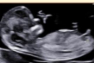 Fetal and Gynae Imaging | Fetal Ultrasound Program | Gynae Ultrasound ...